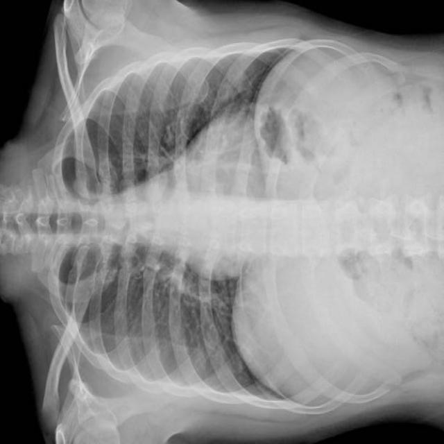 bone cancer Instance Segmentation Dataset by Gunta