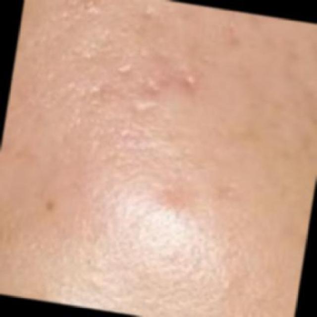 Acne classification Classification Model by tesy