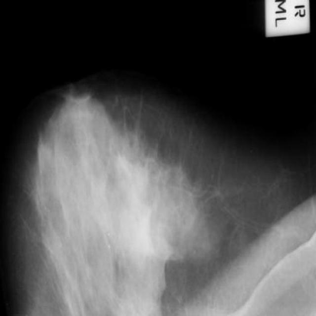 Breast Cancer Detection Object Detection Dataset And Pre Trained Model By Breast Cancer Detection