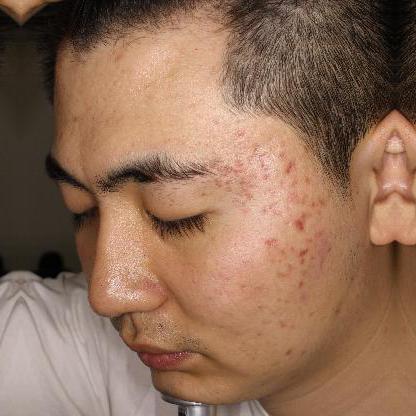 ACNEDet v1 dark_spots Object Detection Dataset and Pre-Trained Model by ML