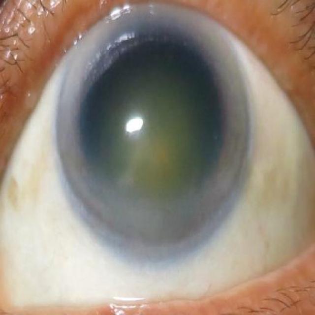 Cataract Detection Object Detection Dataset by Jonathan Chandra