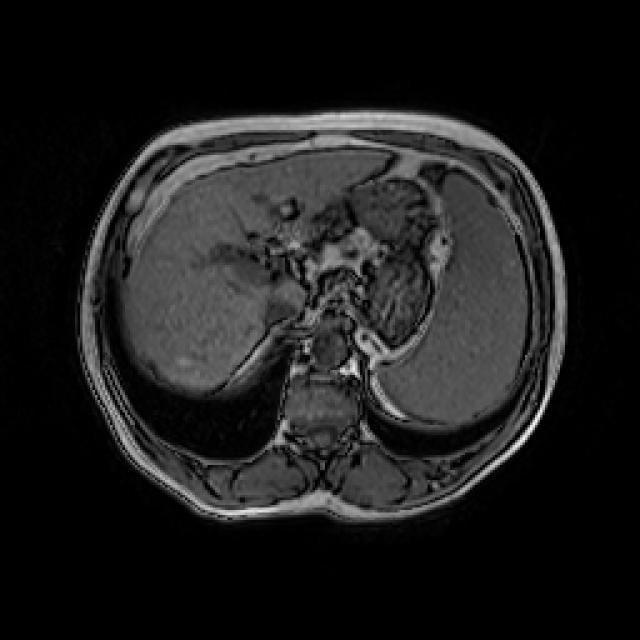 Liver Tumor Detection Classification Dataset and Pre-Trained Model by ...