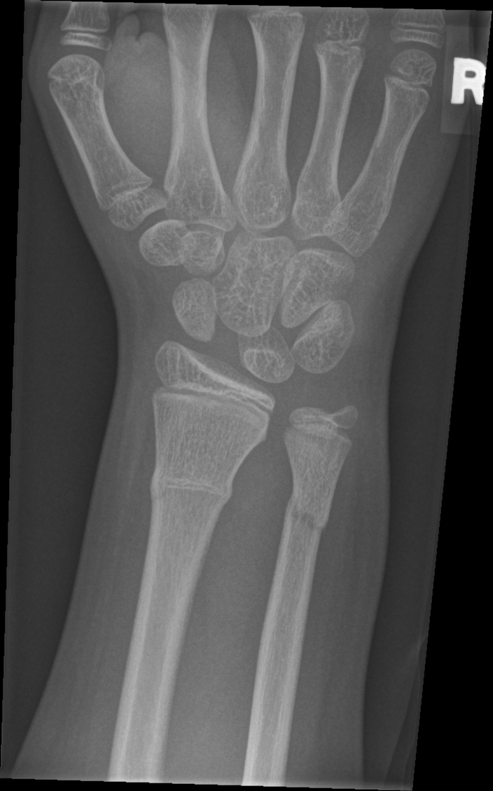 How to Use the bone Object Detection API