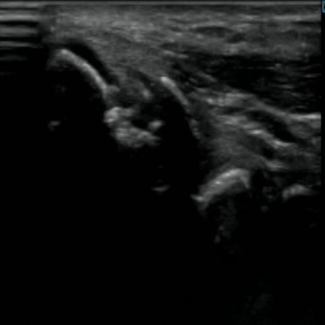 ME detection for JSOA ver2 Object Detection Model by ktkoto