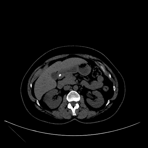 kidney Instance Segmentation Model by kidney