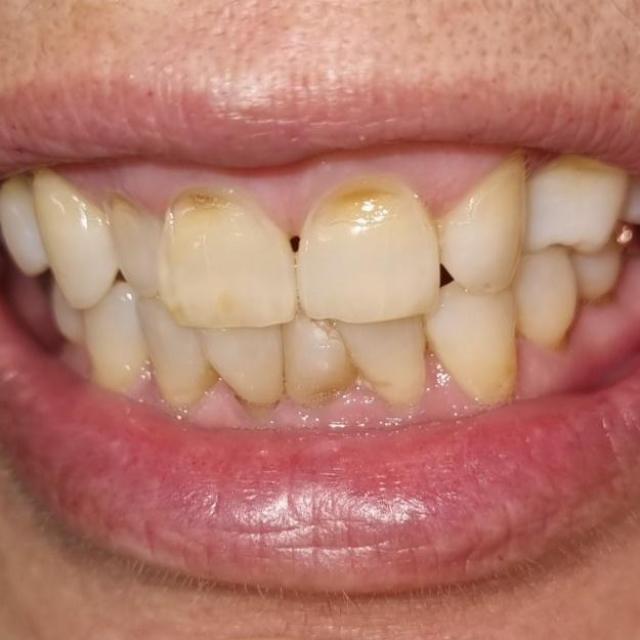 Caries_Grade_Detection Object Detection Model by Dental GAIA