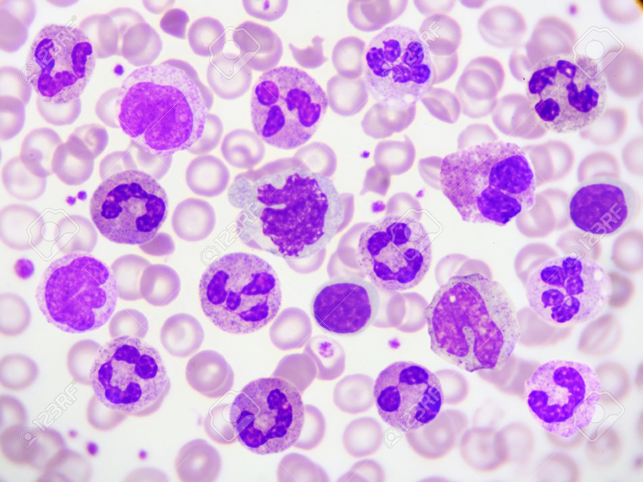 blood cancer Object Detection Dataset by Blood cancer
