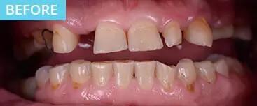Class 2 : Single Tooth Loss Object Detection Dataset by DentalMatev7