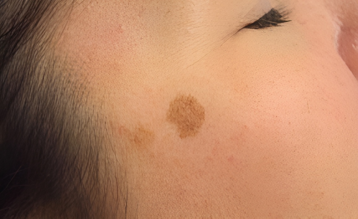 dark spot Instance Segmentation Dataset by Shehneel Khan