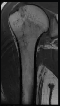 Scapula And Humerus Instance Segmentation Dataset and Pre-Trained Model by YOLOv8 Tabanl Tbbi ...