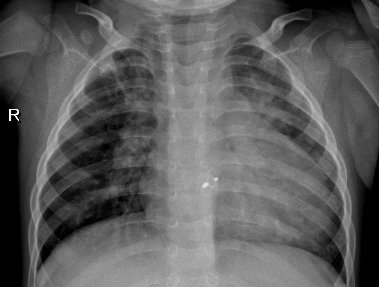 pediatric_pneumonia Object Detection Dataset by lungcxr