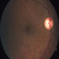 diabetic retinopathy Object Detection Dataset by lens defect detection