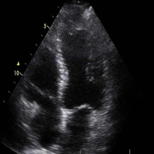 MV LV DETECTION Instance Segmentation Dataset and Pre-Trained Model by Mitral Valve