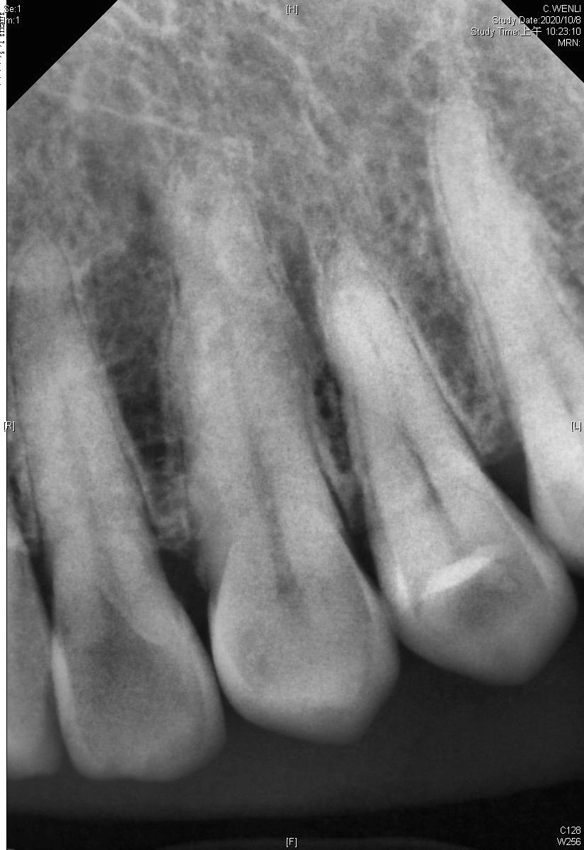 bone loss Inception_v3 Classification Dataset by test
