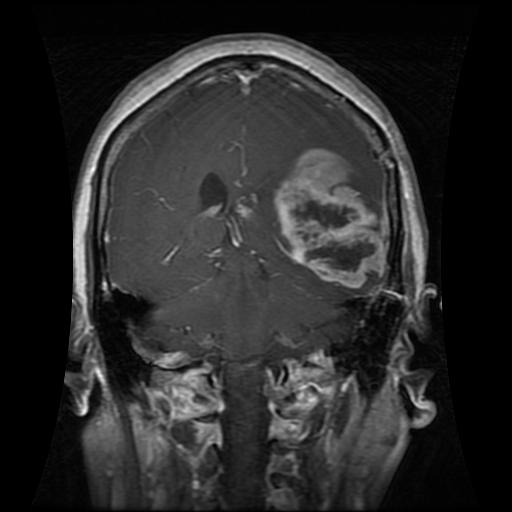 Brain Tumor Detection Yolo8 Object Detection Model By Brain Tumor