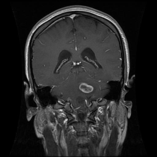 yolo-nas-btdetection Object Detection Dataset and Pre-Trained Model by brain tumor