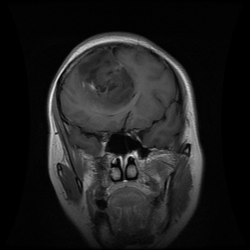 Brain Tumor Detection Mri Object Detection Dataset By Computer Vision