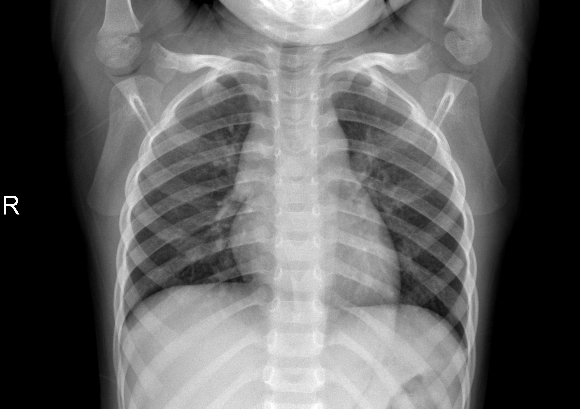Chestxray Classification Model by Tape