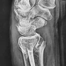 Wrist Fracture Classification Classification Model by shreyash79