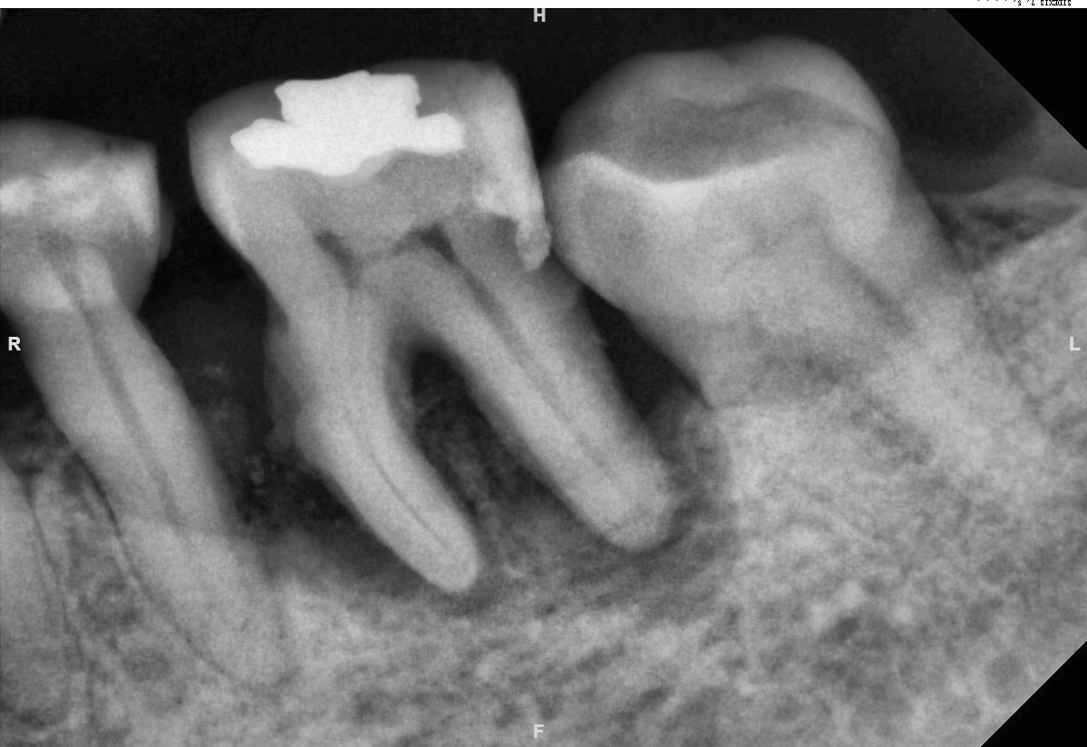 tooth_data_v1_0308_GRAY_AHE_01 Object Detection Dataset by Lab
