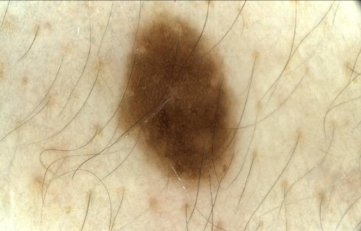 cancer_detection Object Detection Model by skincancer