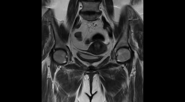 mri_OD Object Detection Dataset and Pre-Trained Model by Sumitha