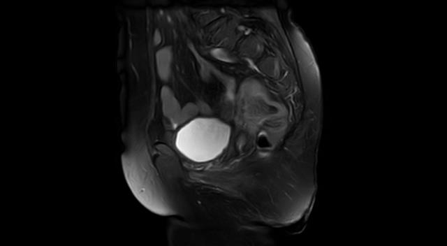 mri_OD Object Detection Model by Sumitha
