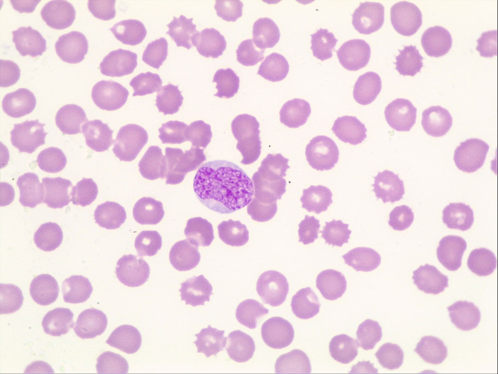 leukemia detection Object Detection Dataset by Tawan