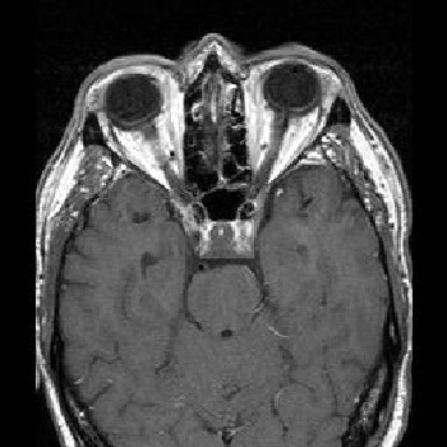 Brain Tumor Detection Object Detection Dataset And Pre Trained Model By