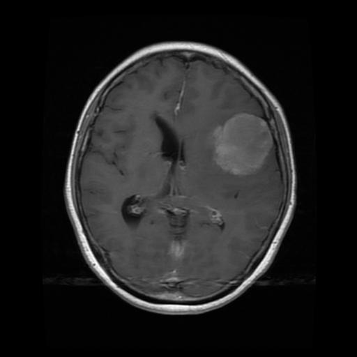 Brain Tumor Detetction Object Detection Dataset And Pre Trained Model By Projects