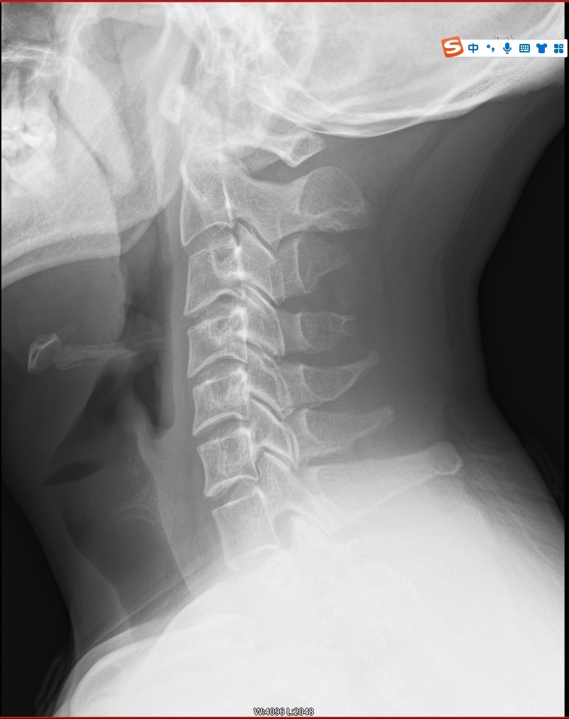 Segmemtation Instance Segmentation Dataset And Pre Trained Model By Cervical Vertebrae