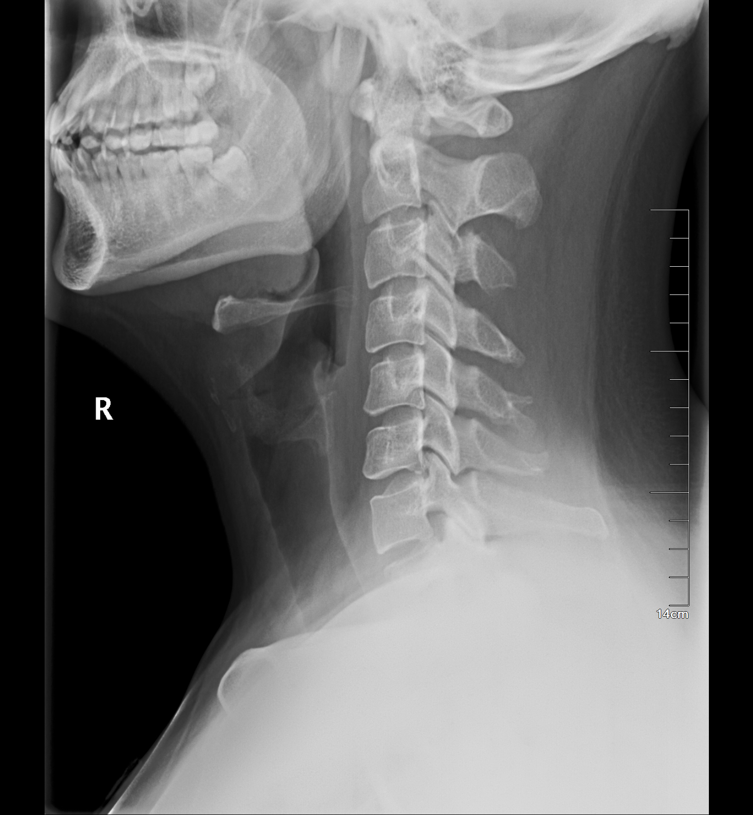 Cervical Segmentation Instance Segmentation Model V1 2024 10 28 3