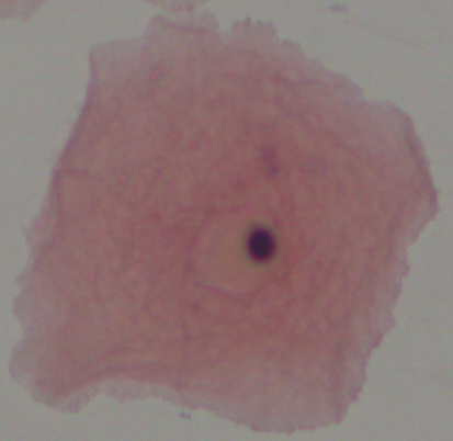 cervical cancer Object Detection Model by Dewinter