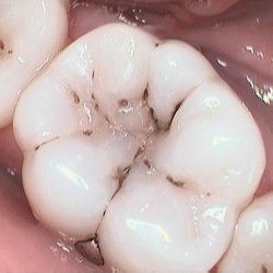 tooth decay Object Detection Dataset by new-workspace-jmblq