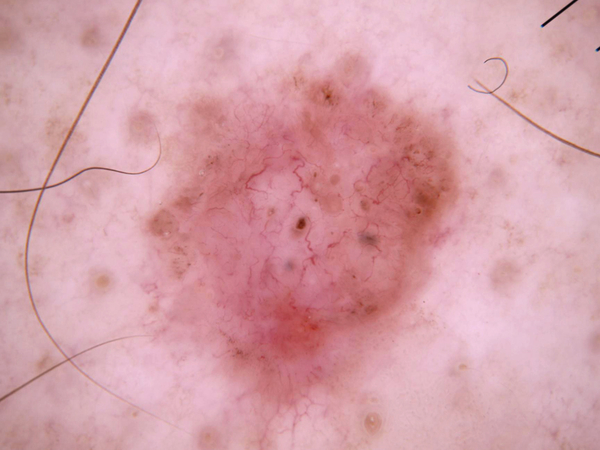 Skin Cancer Object Detection Model By Skin Cancer