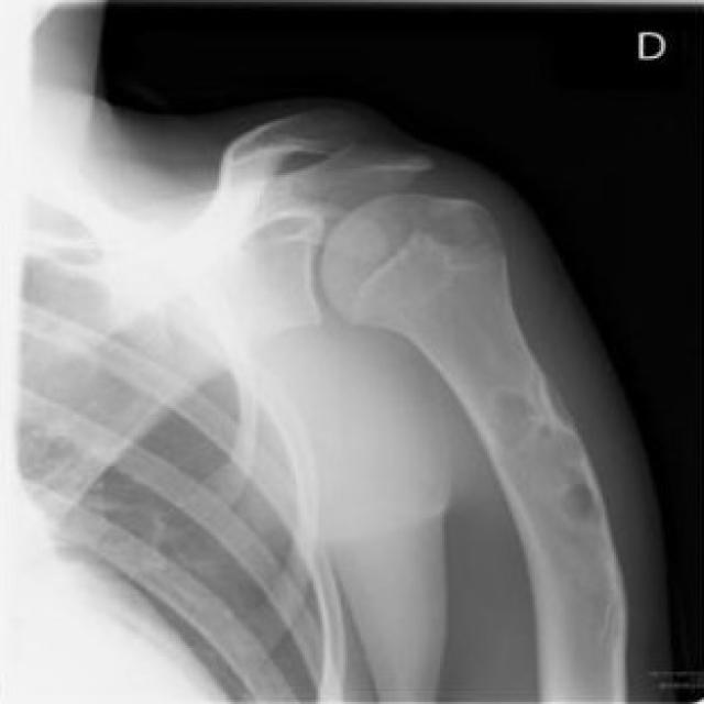 Bone x-rays Object Detection Model by Pracainzynierska