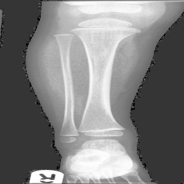bone Classification Model by bone