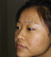 Acne Object Detection Dataset by Kritsakorn