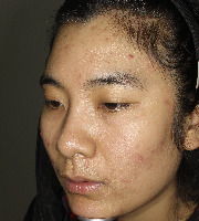 Acne Object Detection Dataset by Kritsakorn