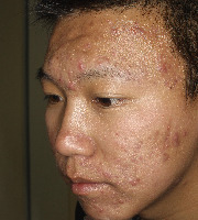 Acne Object Detection Dataset by Kritsakorn