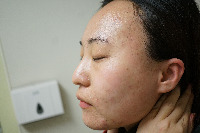 Acne Object Detection Dataset by Kritsakorn