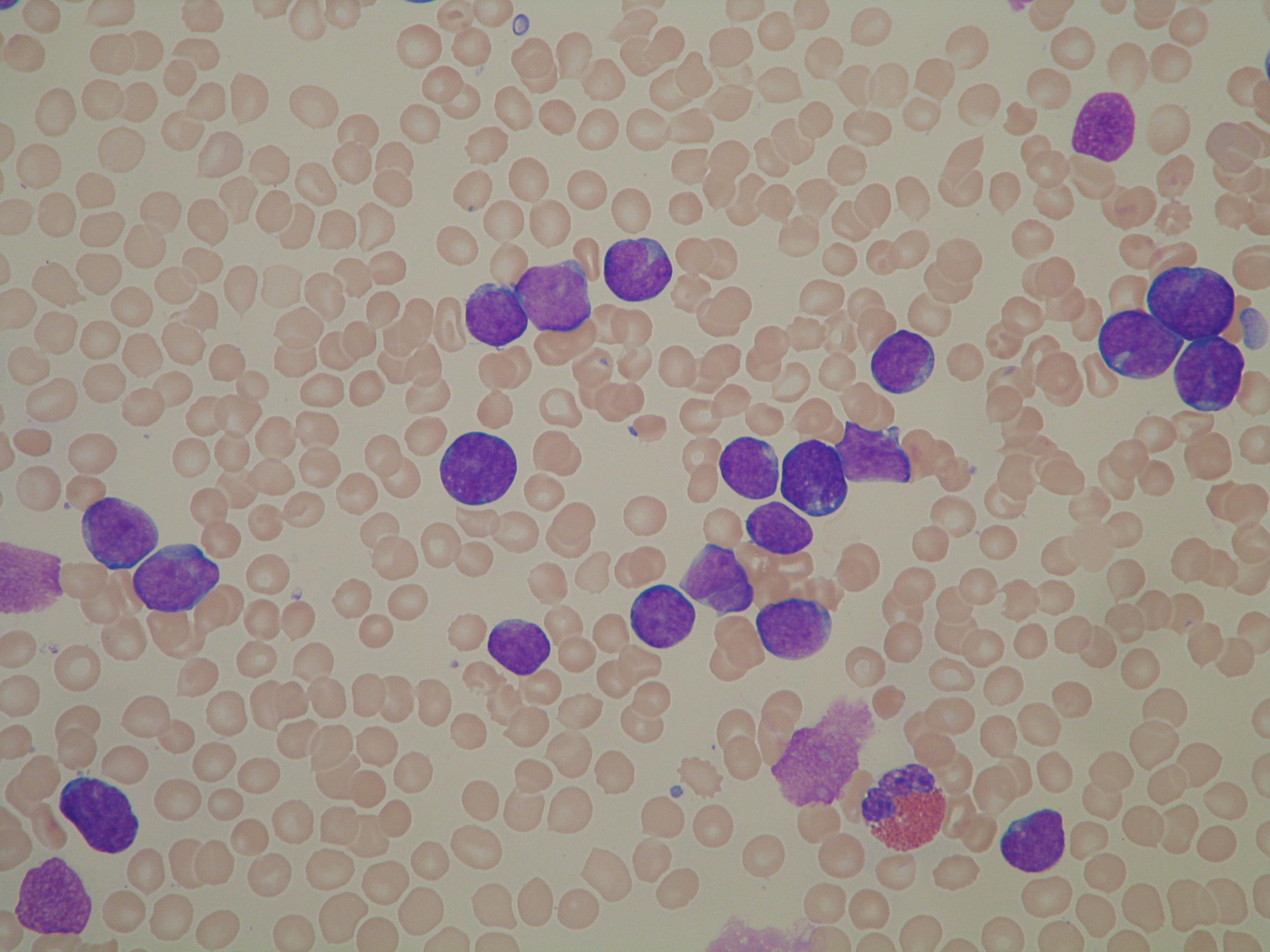 Leukemia Object Detection Dataset by Grad