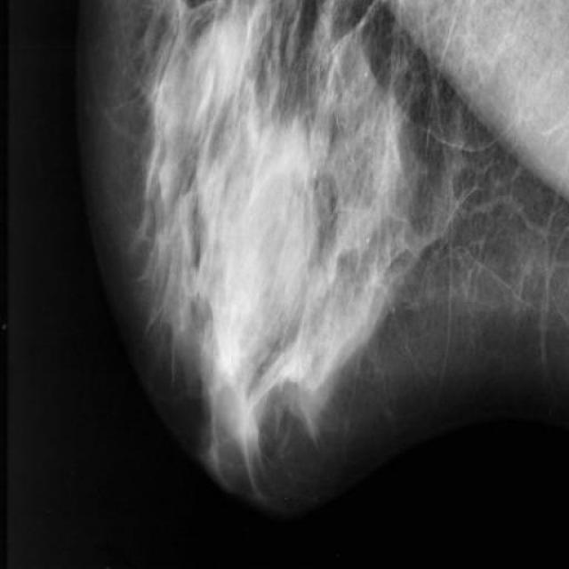 Cancer Detecion Object Detection Dataset And Pre Trained Model By Breast Cancer Detection Va