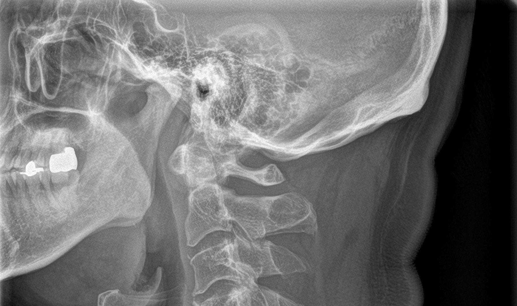 Bones Instance Segmentation Model by AAA