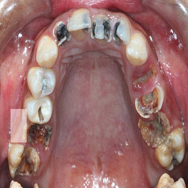 Gingivitis Object Detection Dataset By G H Raisoni College Of Engineering