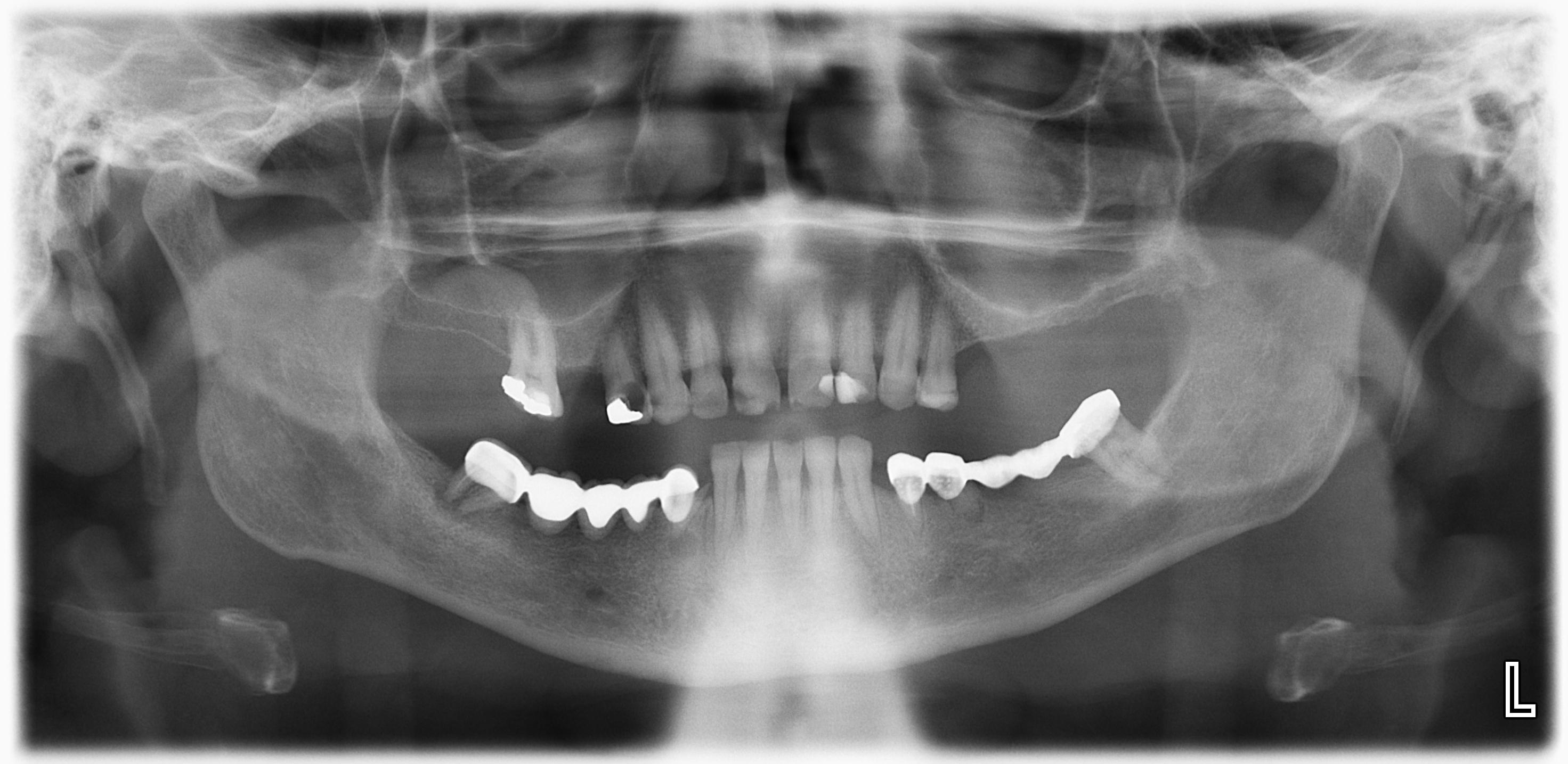 tooth Object Detection Model by blah