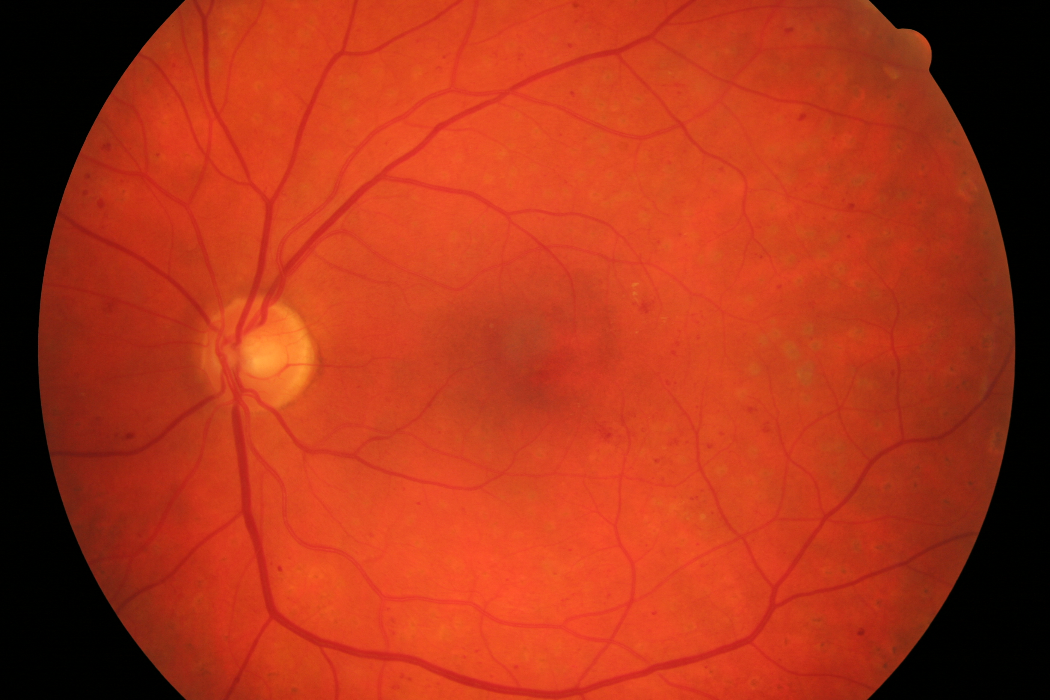 fundus Classification Dataset by emo ahmed