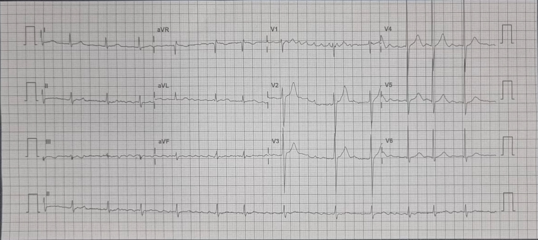 How To Use The Ecg Detection Ver1 Object Detection Api