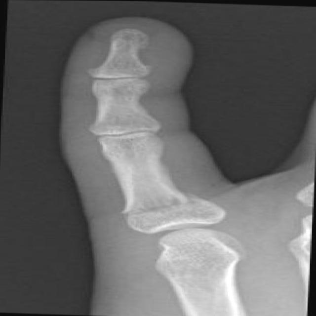 Bone Fracture Detection Object Detection Dataset by melih