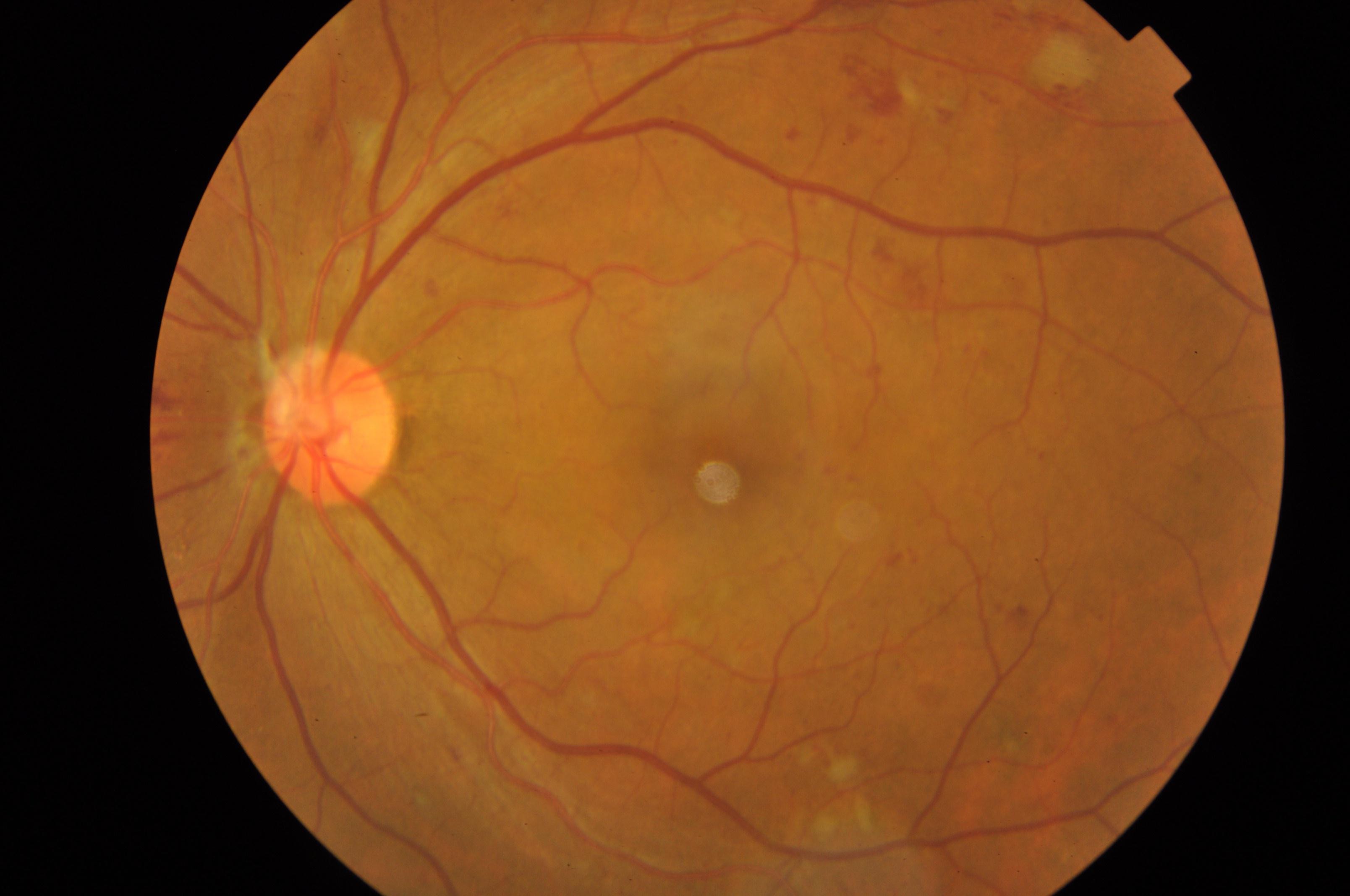Glaucoma Detection Classification Dataset And Pre Trained Model By Testone